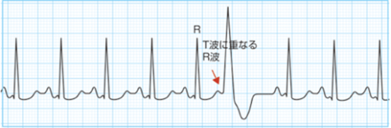 心電図の基礎から実践までをわかりやすく！ | ヘルスノート